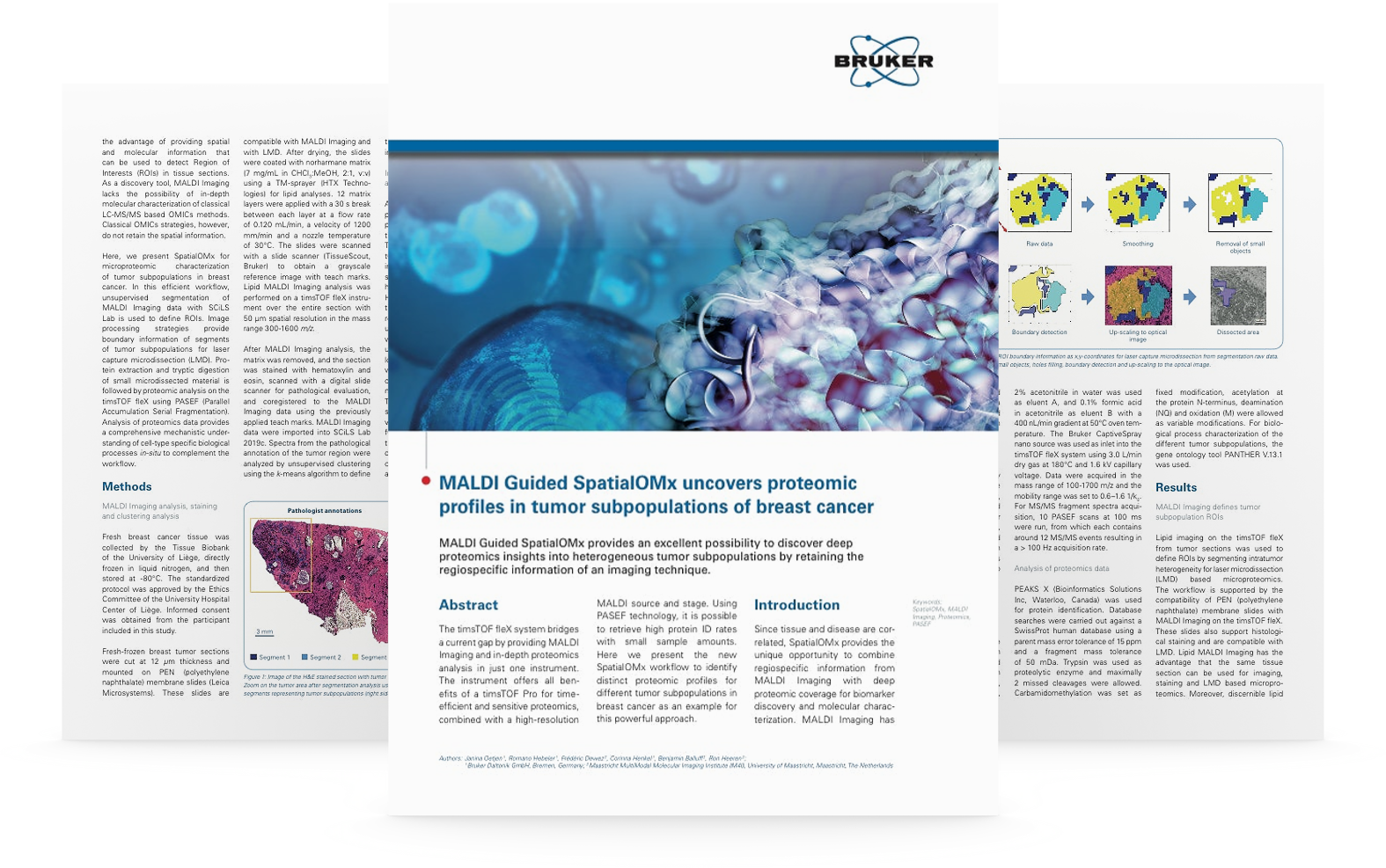 MALDI Guided SpatialOMx uncovers proteomic profiles in tumor subpopulations of breast cancer